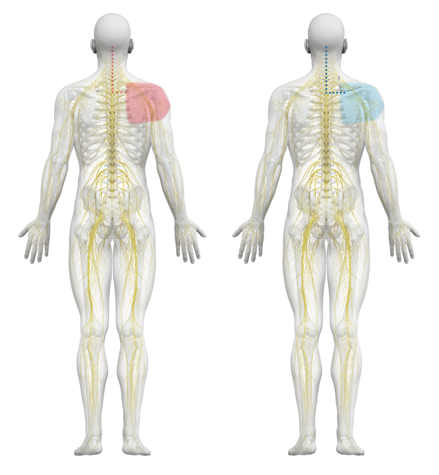 Peripheral Nerve Stimulator Nalu Medical
