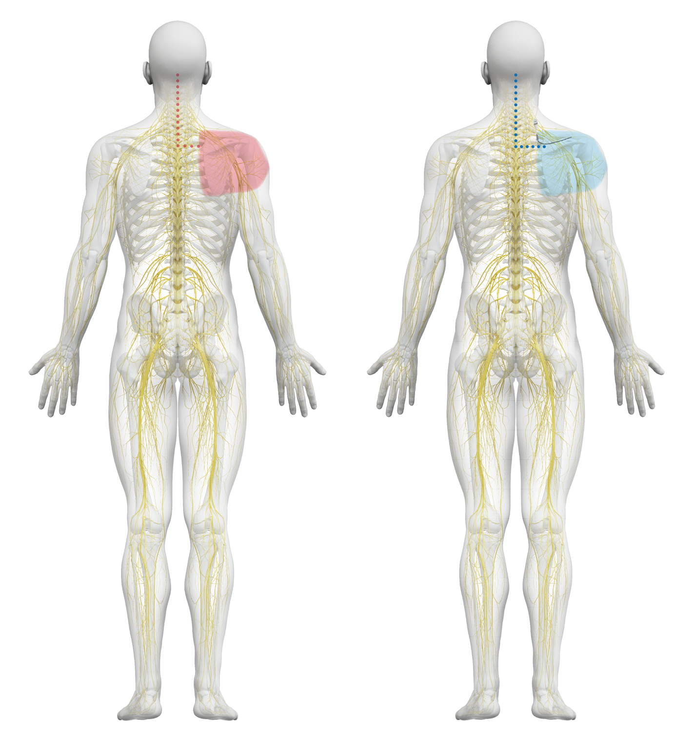 Peripheral Nerve Stimulator | Nalu Medical